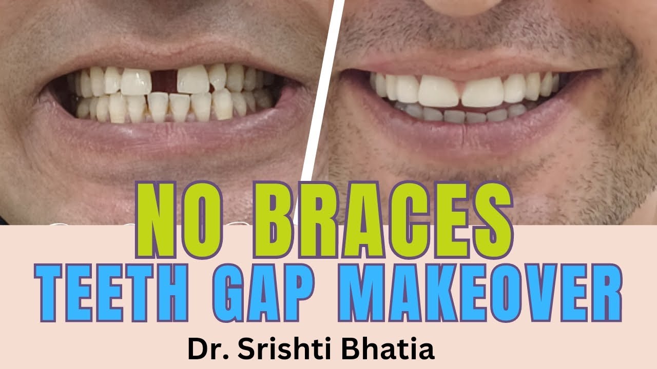 NO BRACES Teeth Gap Makeover; Dr. Srishti Bhatia #smilemakeover - YouTube