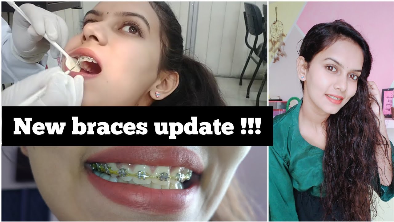 Braces update video!! || Major changes in teeth #howto #braces # ...