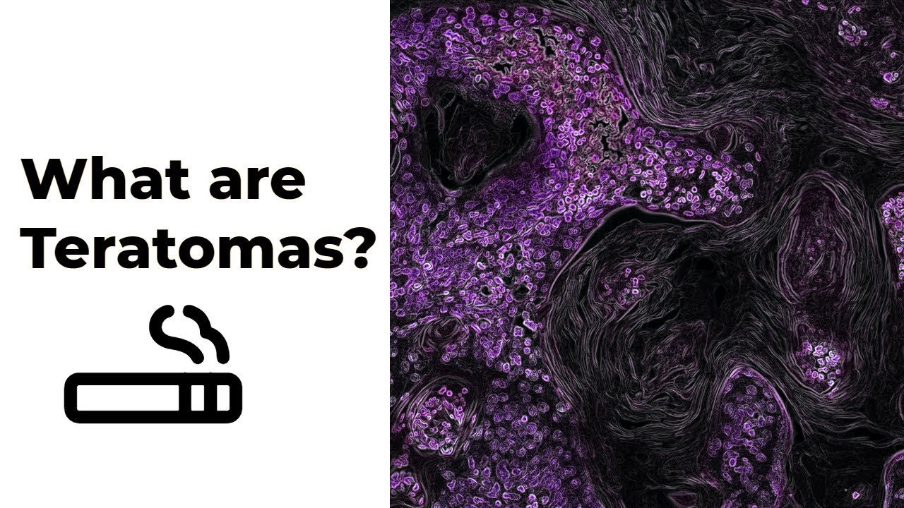 What are teratomas?| Explained| Cancer Biology - YouTube