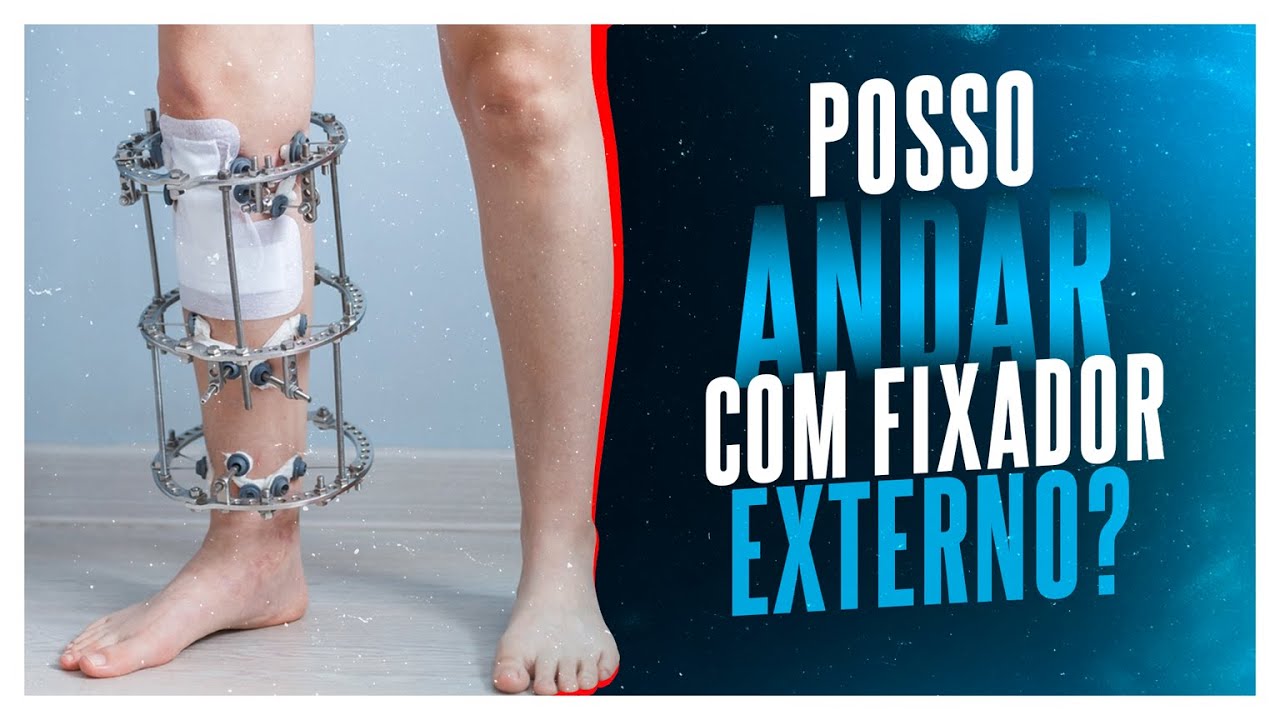 POSSO ANDAR COM FIXADOR EXTERNO - Dr. Américo Barbosa - YouTube