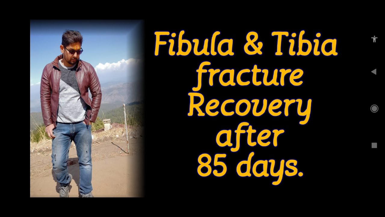 Fibula & Tibia fracture Recovery after 85 days|| stitches removed||ठीक ...
