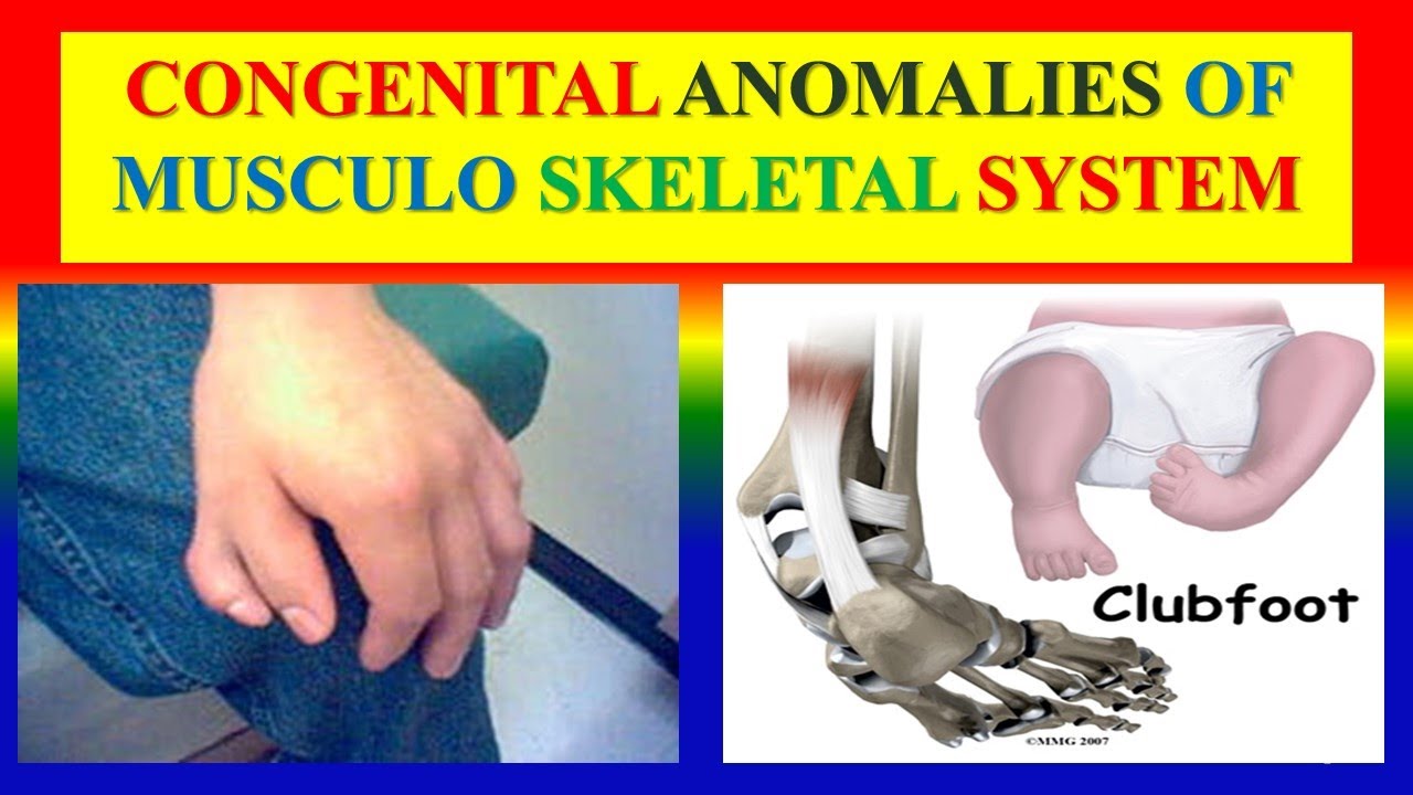 CONGENITAL ANOMALIES OF MUSCULO SKELETAL SYSTEM Classification