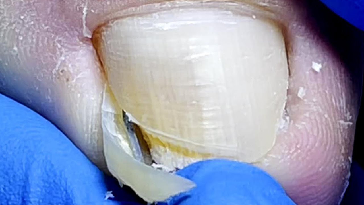 Cut off the ingrown toenail first, then thin the onychomycosis - YouTube