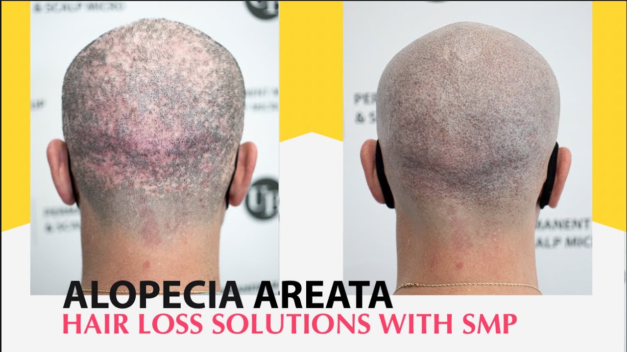 Treating Alopecia Areata with Scalp Micropigmentation - YouTube