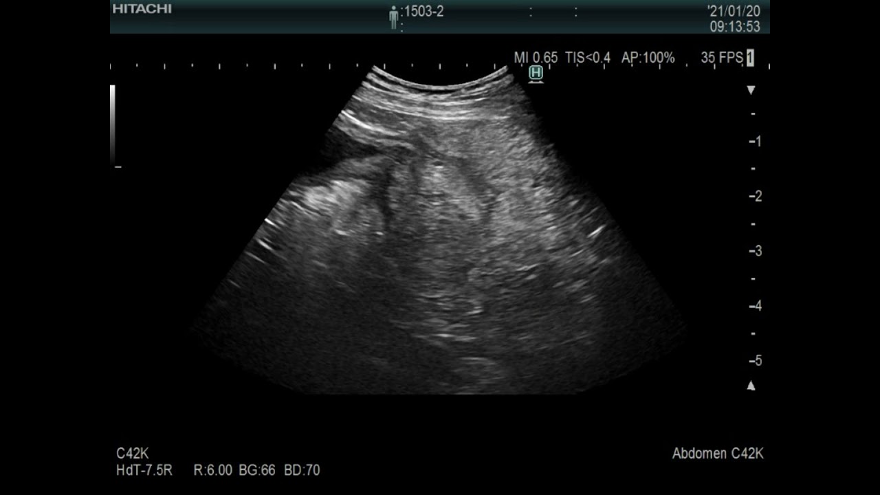Benign prostatic hyperplasia in a dog（犬の良性の前立腺肥大） - YouTube