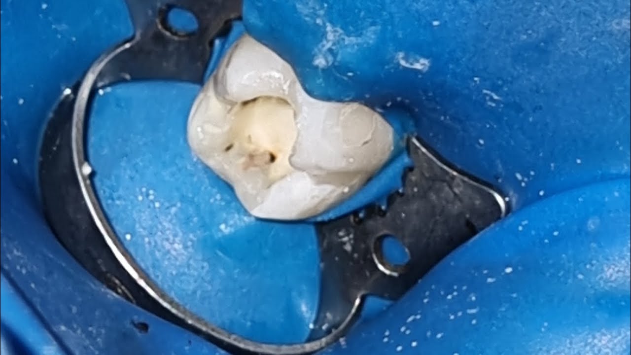 Dente 47 - canal e restauração - YouTube