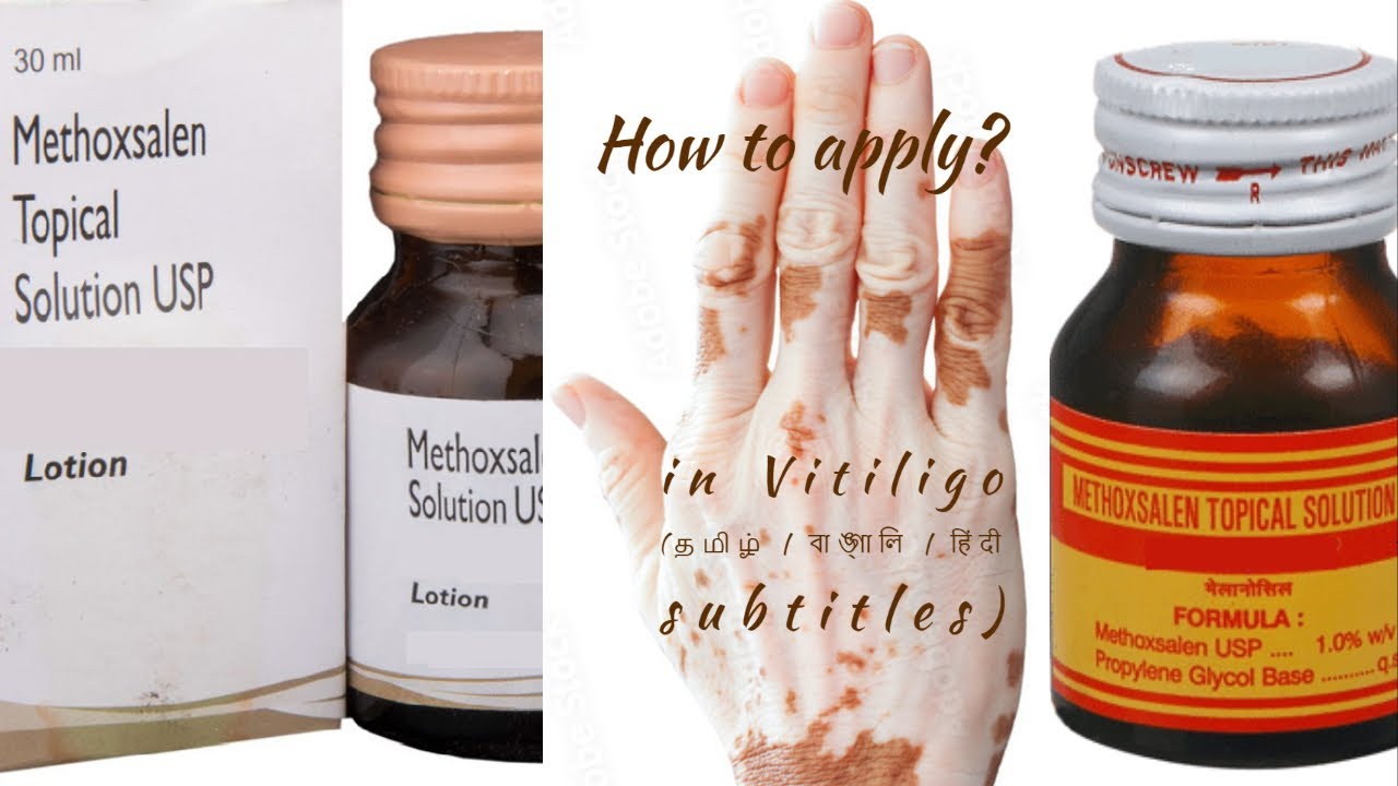 How to apply Methoxsalen solution in vitiligo? | Soak PUVA-Sol |Method ...