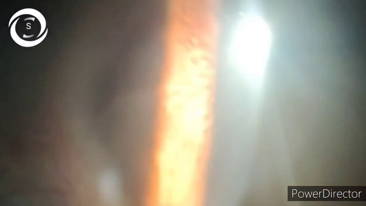 Fuchs Uveitis Syndrome CC40 - YouTube