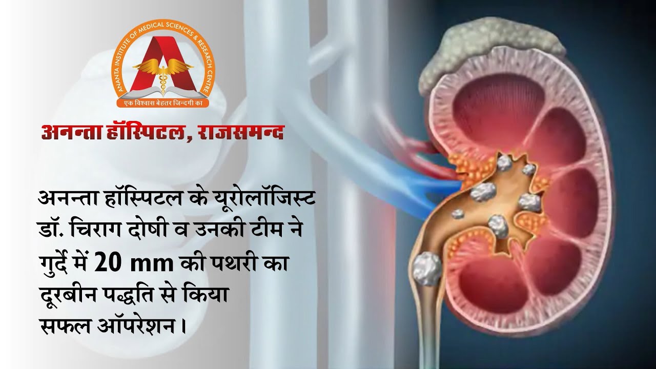 गुर्दे में 20 mm की पथरी का दूरबीन पद्धति से किया सफल ऑपरेशन - YouTube