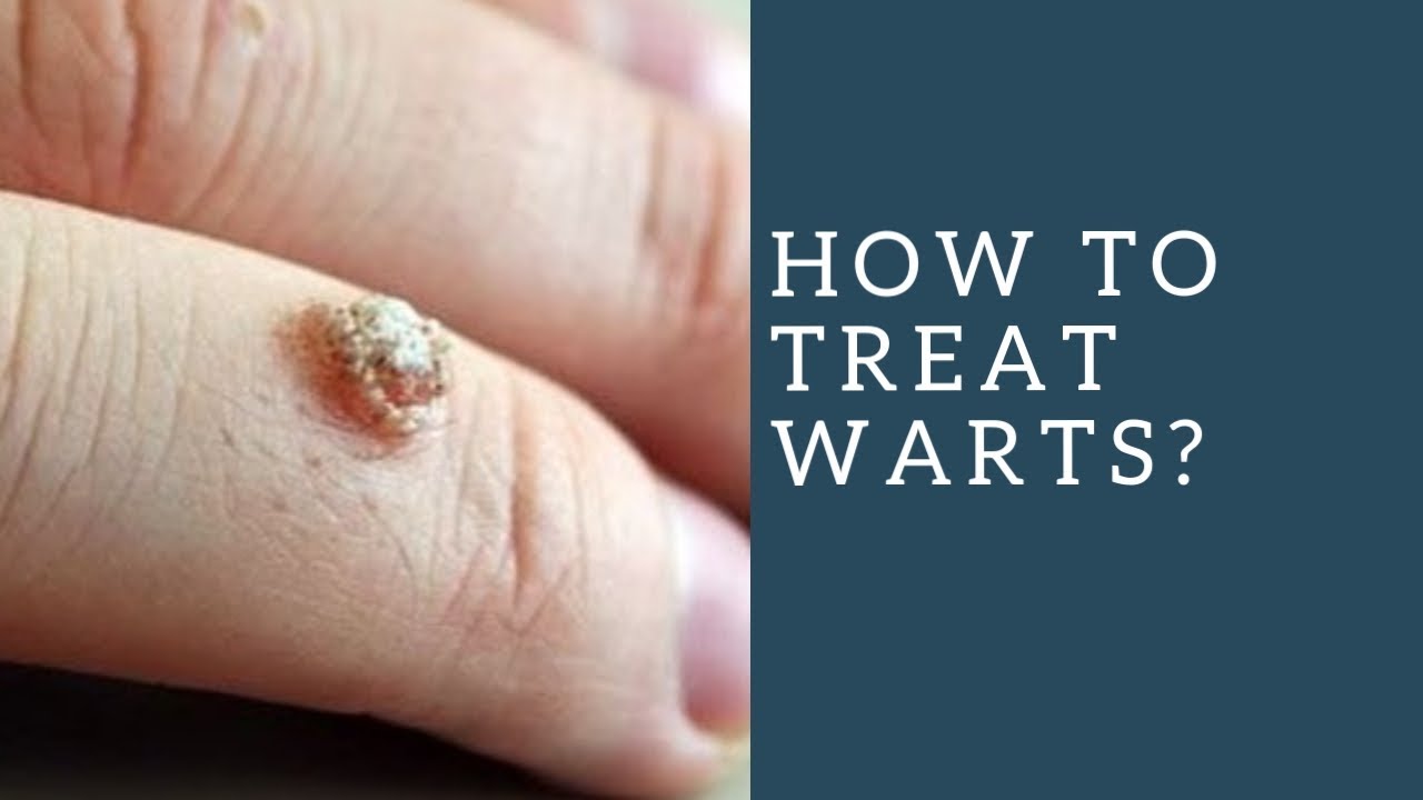 Warts Removal With Laser Youtube