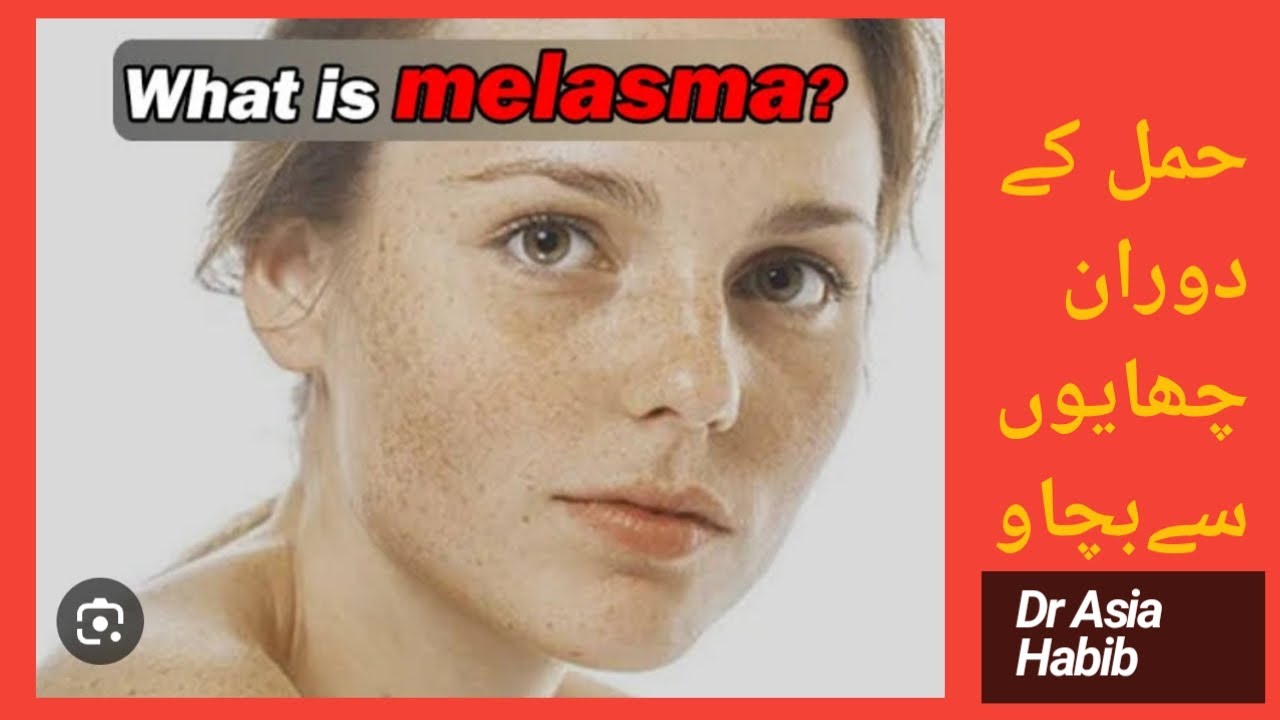 Hyperpigmentation Melasma| how to reduce melasma pigmentation - YouTube