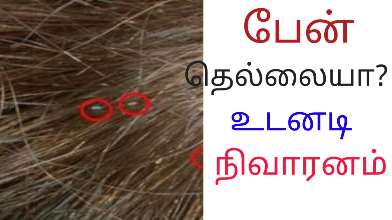 how To Remove In Lice In Tamil YouTube