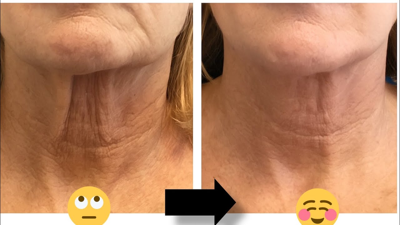 A BEAUTIFUL Neck with Just SIMPLE remedies.How to Get Rid of Venus ...