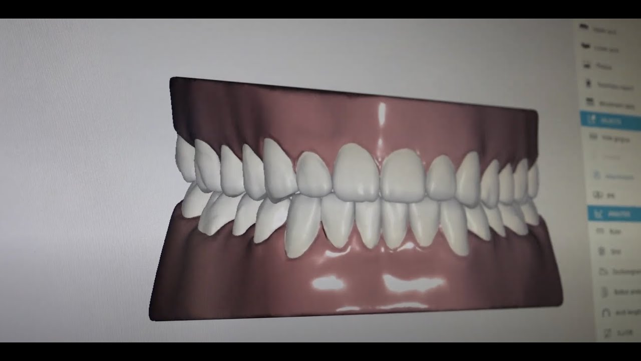 The Transparent Explanation of Clear Aligners - Have questions about "Invisalign"? Did you know ...