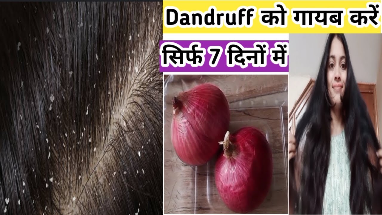 How To Cure Dandruff In 7 Days|Get Rid Of Extreme Dandruff&Hair Fall|7 ...
