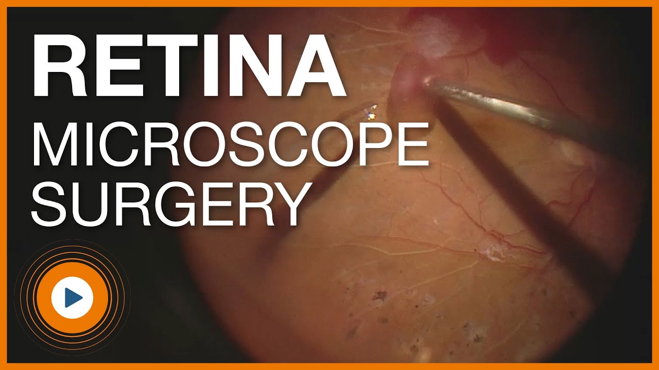 Ophthalmic Posterior Retina Microscope Surgery Video - YouTube