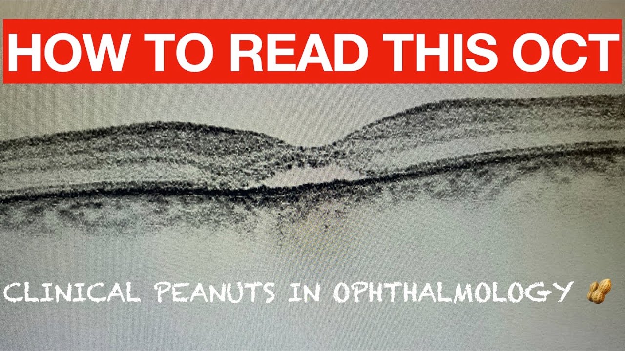 How to read this OCT : SRF Vs Cavitation - YouTube