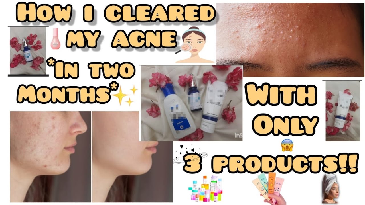 How I Cleared Acne *AFFORDABLE PRODUCTS* Type Of Acne. |glowupwith_me ...