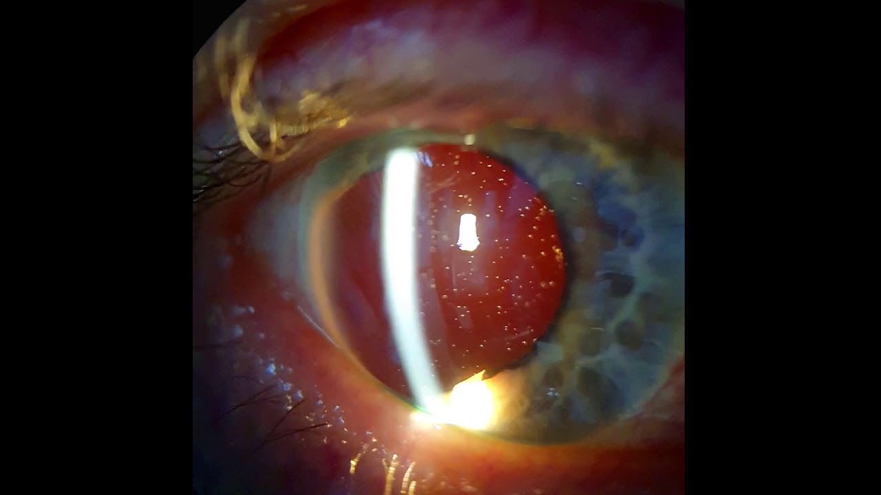 Silicone Oil in an Aphakic eye - YouTube