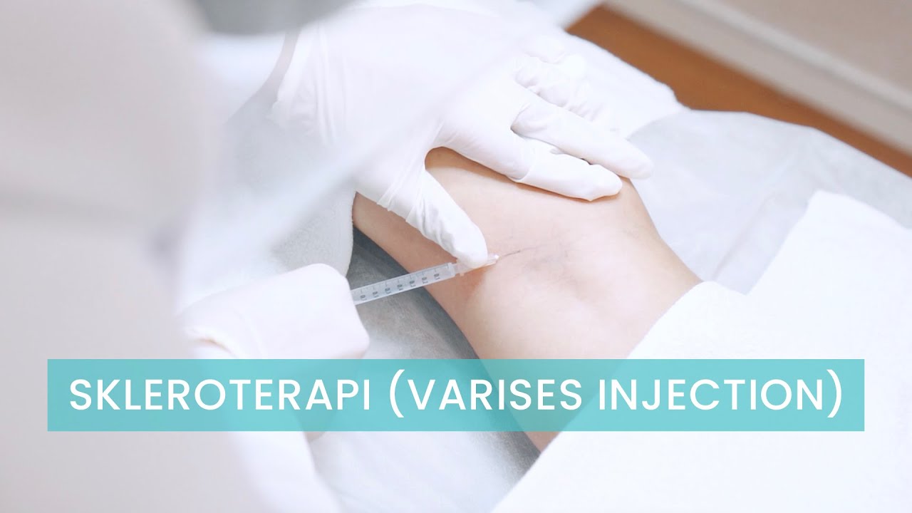 Skin & Co - Injeksi Varises atau Skleroterapi - YouTube