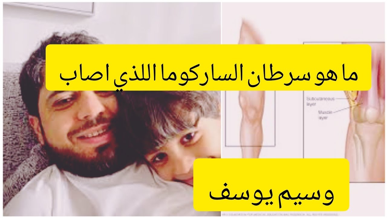 ما هو سرطان ساركوما الذي اصاب وسيم يوسف الاعراض والاسباب والعلاج وسيم