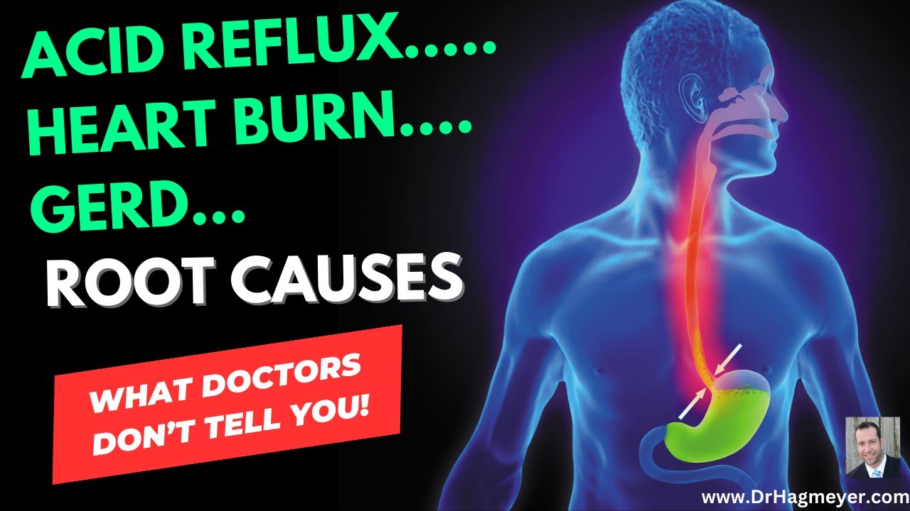 🔥Causes of Acid Reflux a Gerd root causes supplements, liquid ...