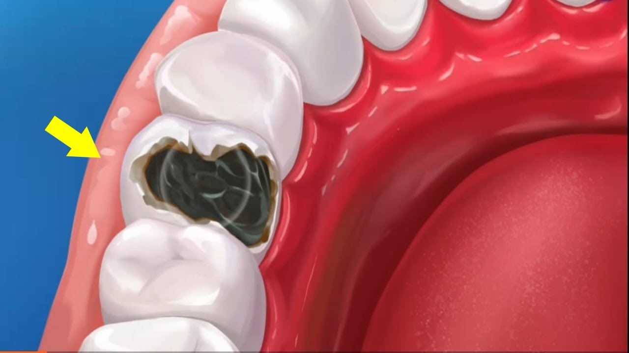 ASMR Remove Decayed tooth# Restoring A Tooth Back To Its Original Shape ...