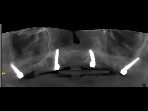 part 1 - anatomy + IOPA guided right pterygoid implant surgery - YouTube