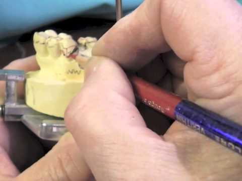 RPD Design - Ken Class II Max Cast #4 Part D - YouTube