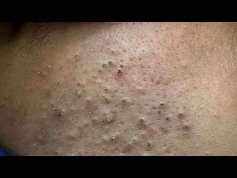 Skincare | Deep Pore Cleansing | Blackhead Removal Session