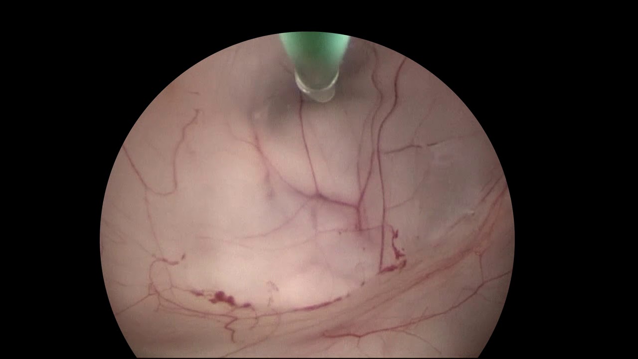 Ventriculocystostomy of Intraparenchymal Cyst with the LOTTA ...