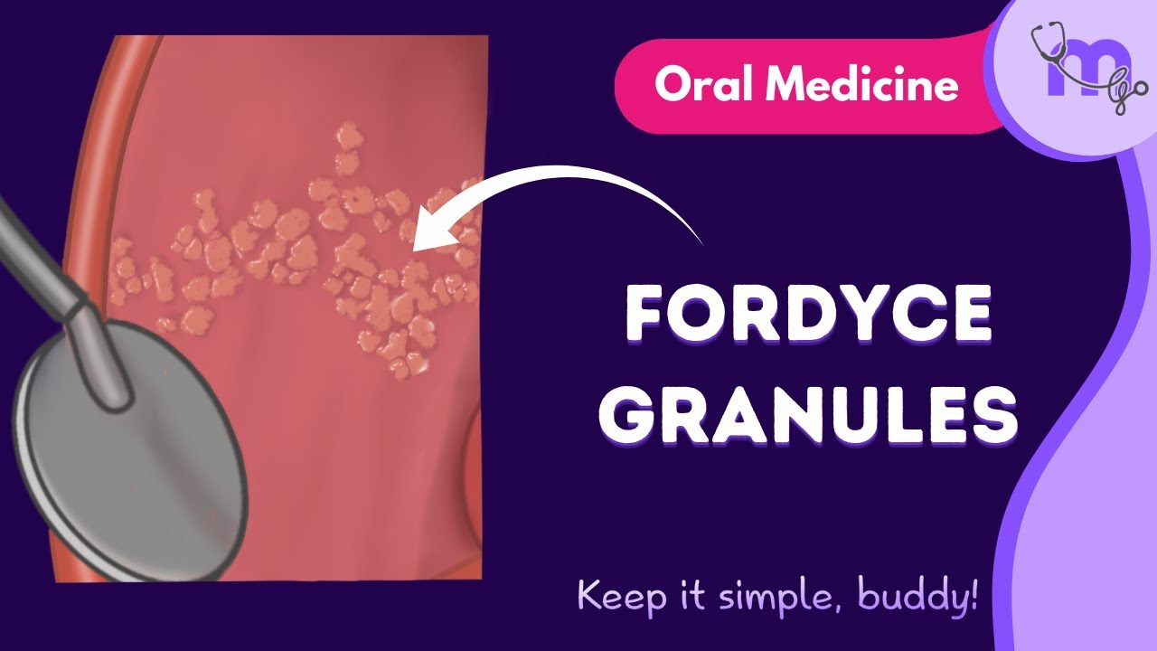 Fordyce Granules - Differential diagnosis , Management | Oral Medicine ...