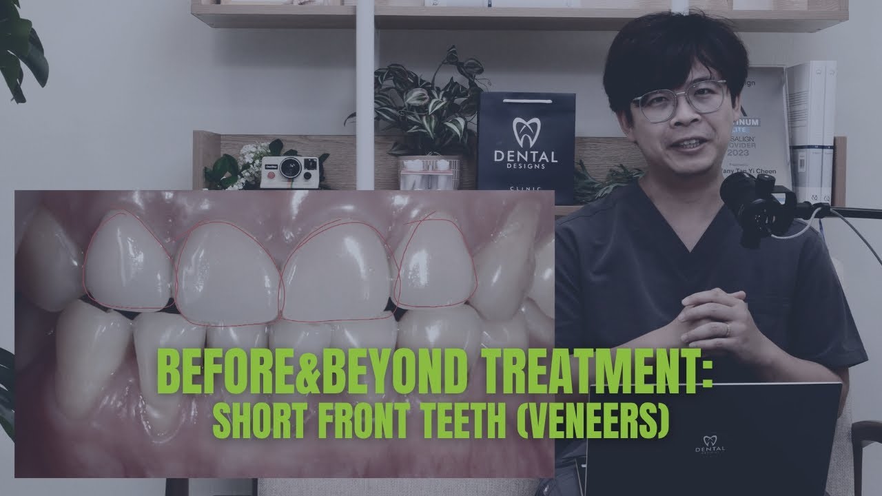 Solutions for Short Front Teeth: What You Need to Know (VENEERS ...