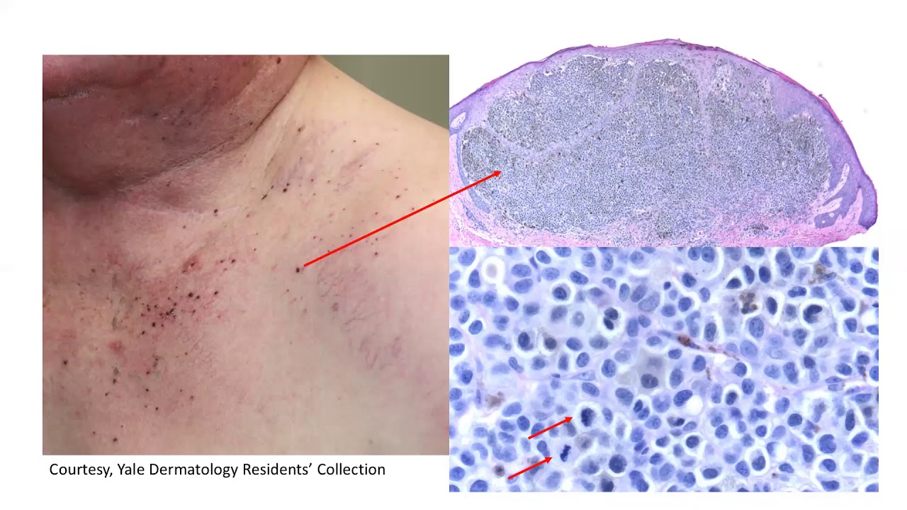 DP60 episode 79 red brown papules on chest - YouTube