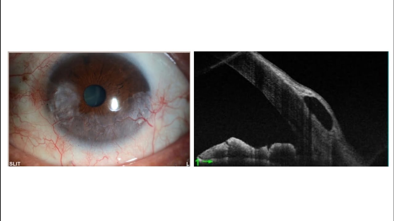 Conjunctival Squamous Papiloma and Anterior Segment OCT - YouTube
