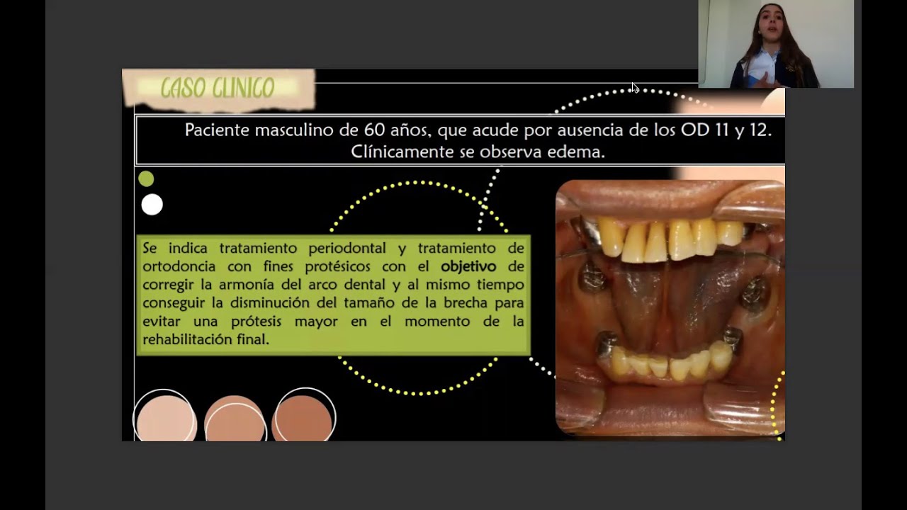 OCC-11 ORTODONCIA CON FINES PROTÉSICOS EN LA REHABILITACIÓN DE UN ...