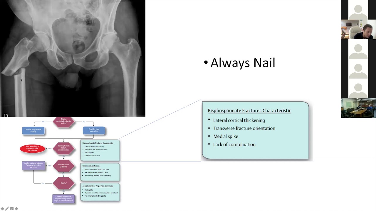 Subtroch Fractures - YouTube