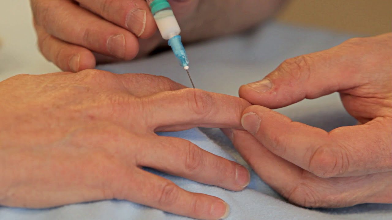 Kortisoninjektion PIP och MCP leder - YouTube