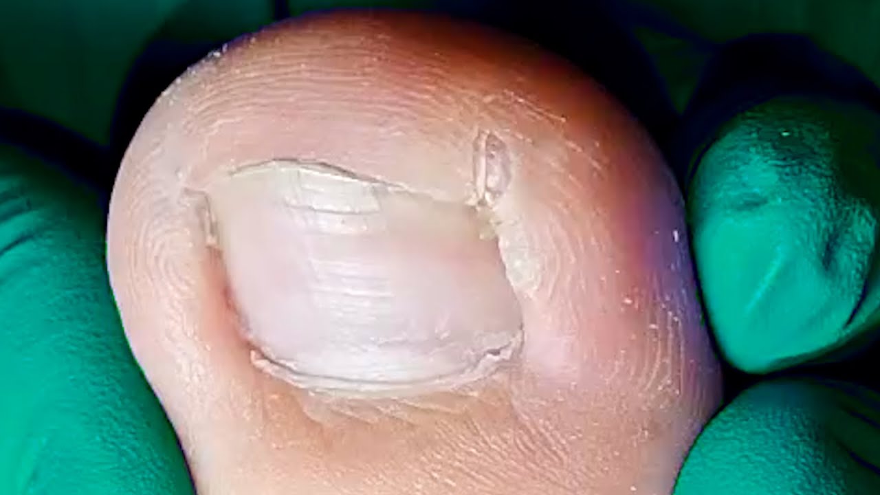 Patient seeks help to treat ingrown toenail problem - YouTube