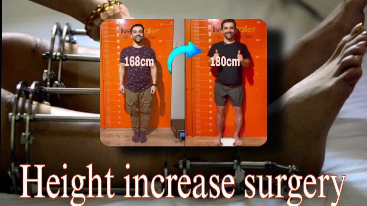 HEIGHT INCREASE SURGERY | IS IT WORTH IT | (FULL GUIDE) IN HINDI - YouTube