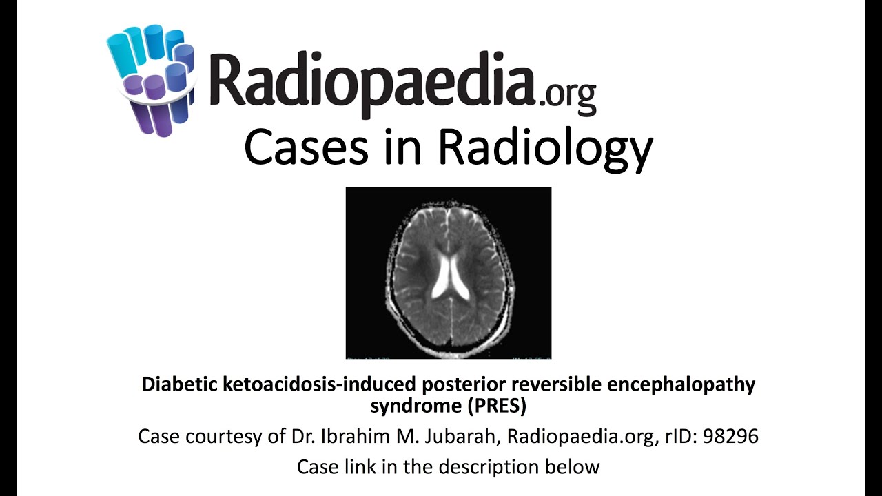 DKA-induced posterior reversible encephalopathy syndrome (PRES ...
