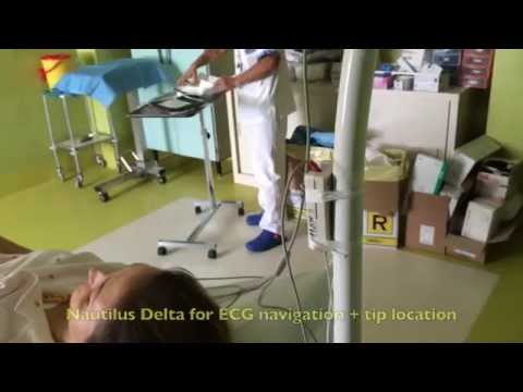 Delta ECG tip locating by Mauro Pittiruti PICC procedure - YouTube
