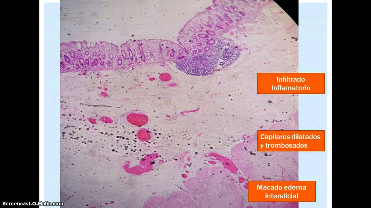 Infarto Isquémico Intestinal Mucoso - YouTube