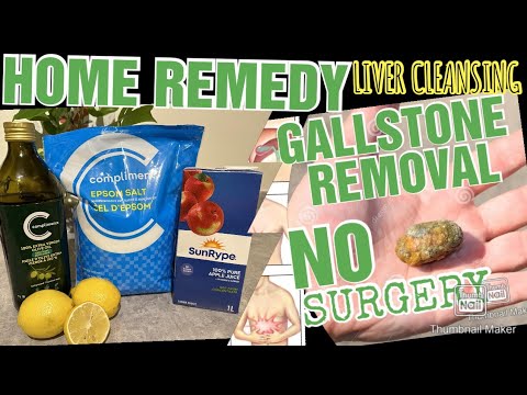 HOW TO REMOVE GALLSTONE WITH NON-SURGICAL TREATMENT - YouTube