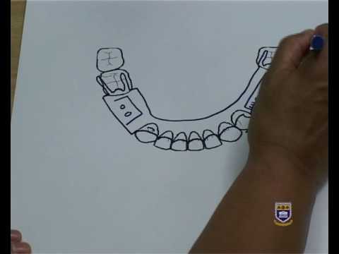 Designing a Lower Metal Partial Denture Kennedy Class III - YouTube