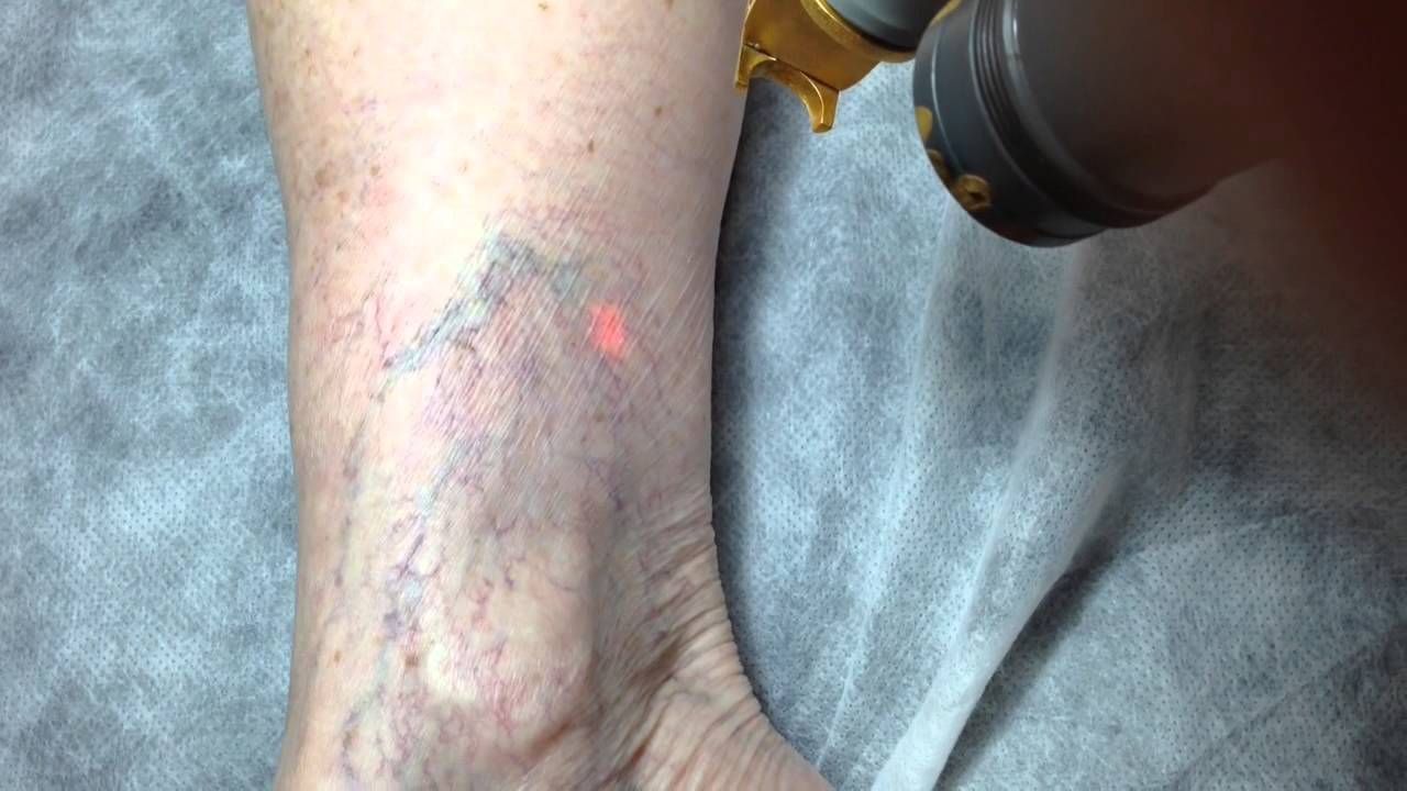 Laser para varices y arañitas 2 - YouTube