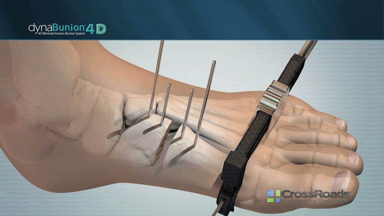 DynaBunion® 4D Minimal-Incision Lapidus System - Featuring Gen 2 ...