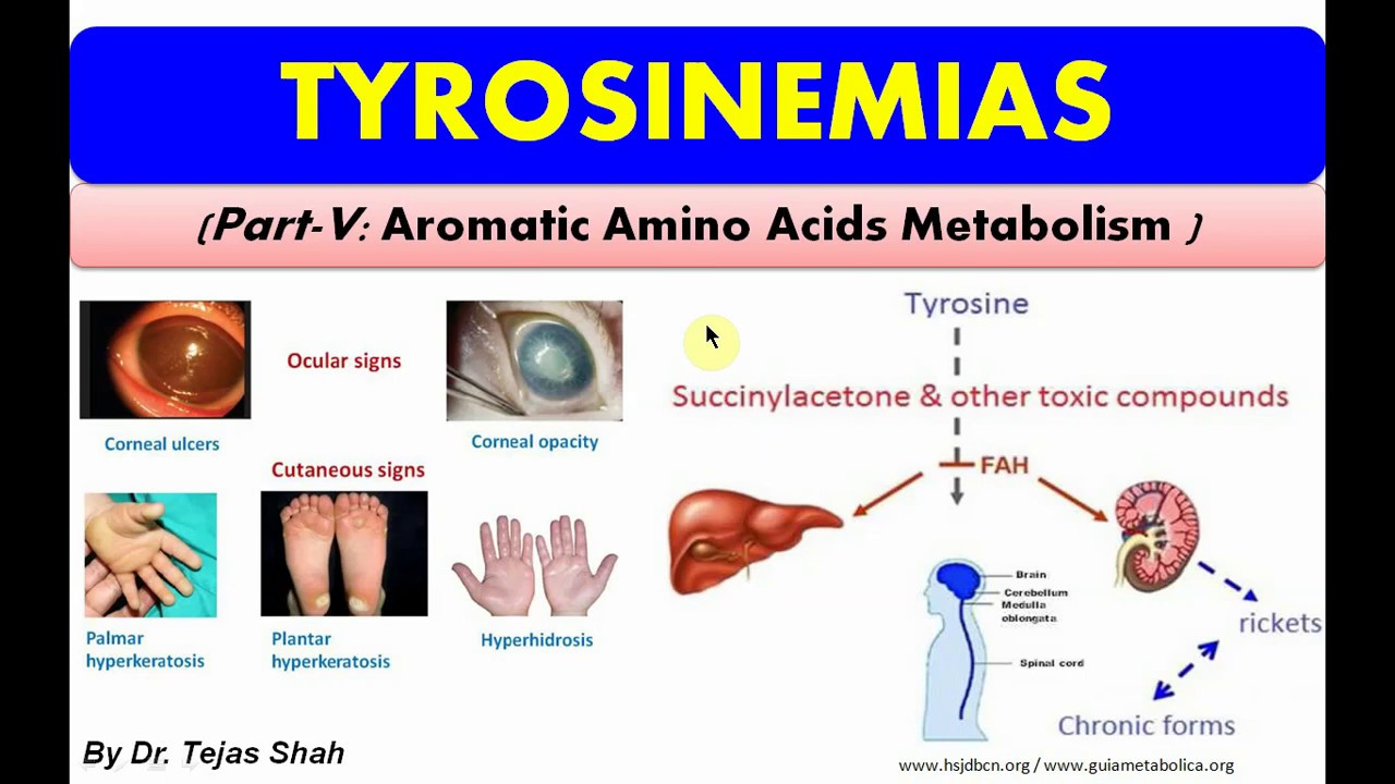 Tyrosinemia Diagnosis