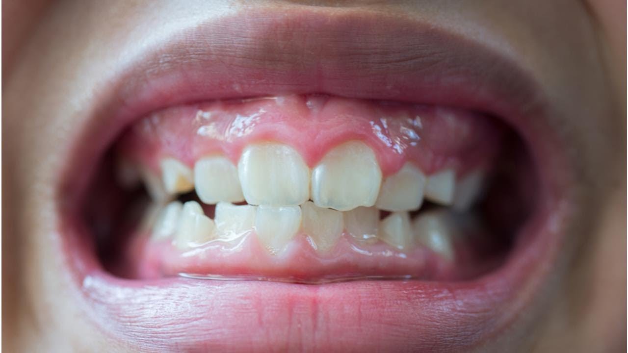 What Causes Small Teeth? | Tita TV - YouTube