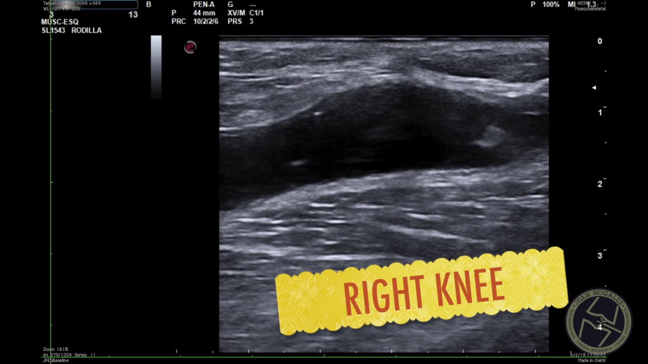 POPLITEAL CYST: ECHO GUIDED PUNCTURE - YouTube